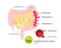 Diverticular Disease & Diverticulitis | Causes & Symptoms | Guts UK