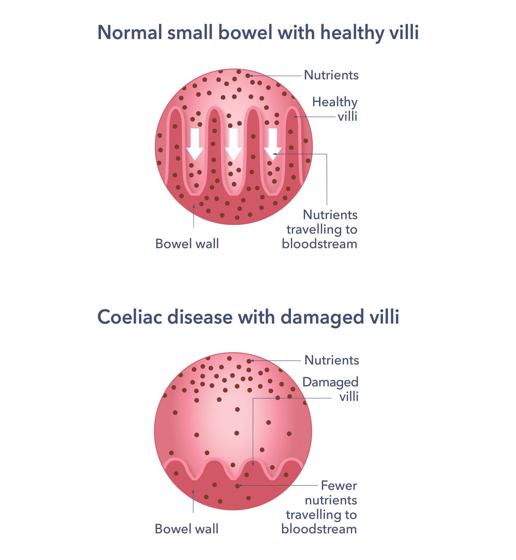 Coeliac Disease | Causes, Symptoms, Treatment and Support