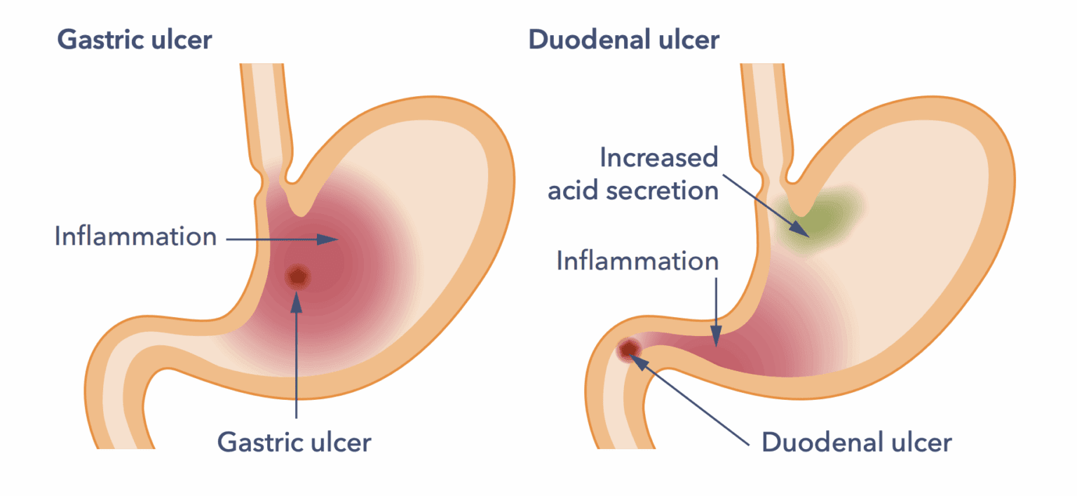 Helicobacter Pylori | Causes, Symptoms, Treatment and Support